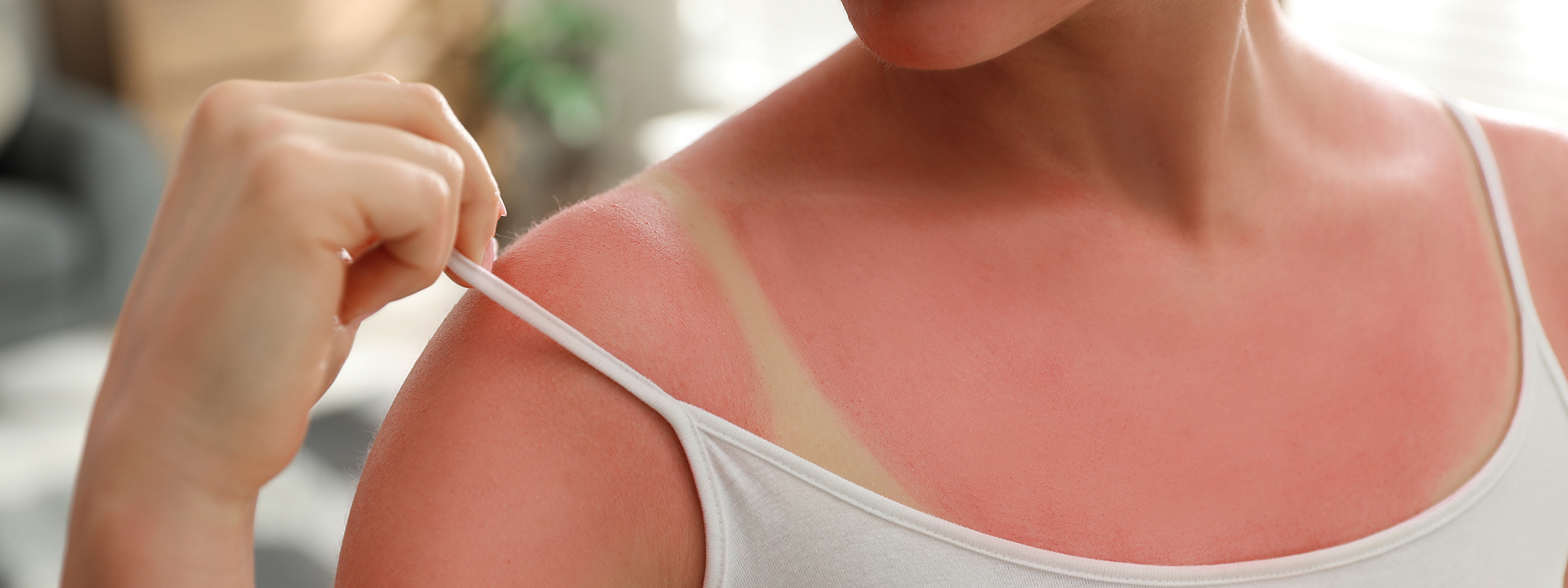 5 Facts About Sunburns You Should Know | Select Health